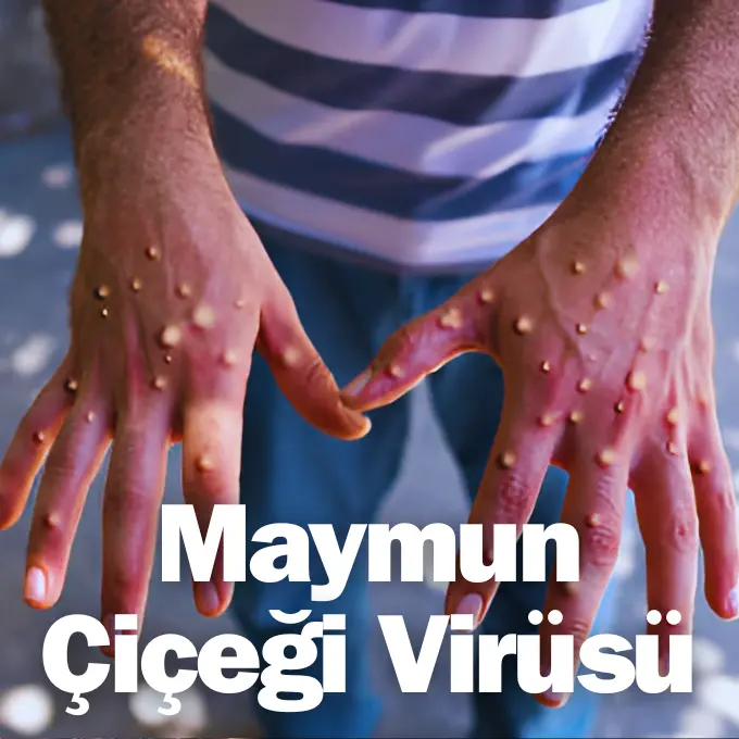 Maymun Çiçeği Virüsü Nedir? Belirtileri ve Tedavisi